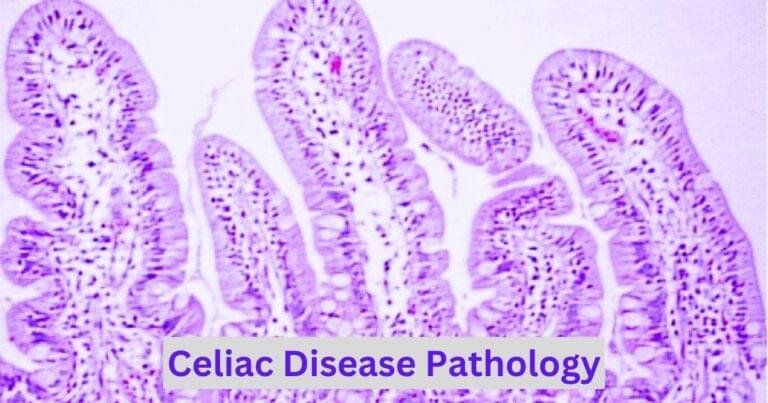 Celiac Disease Pathology: Understanding the Causes, Effects, and ...